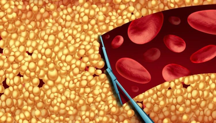 Triglicerídeos Alto: o que significa? Quais são as causas? - SaúdeLab