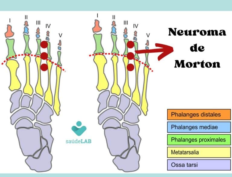 Neuroma de Morton: sapatos apertados ou com bico fino podem causar ...