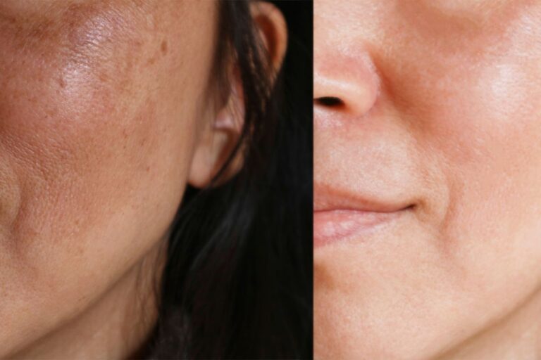 O que é melasma? Quais as causas comuns? Entenda