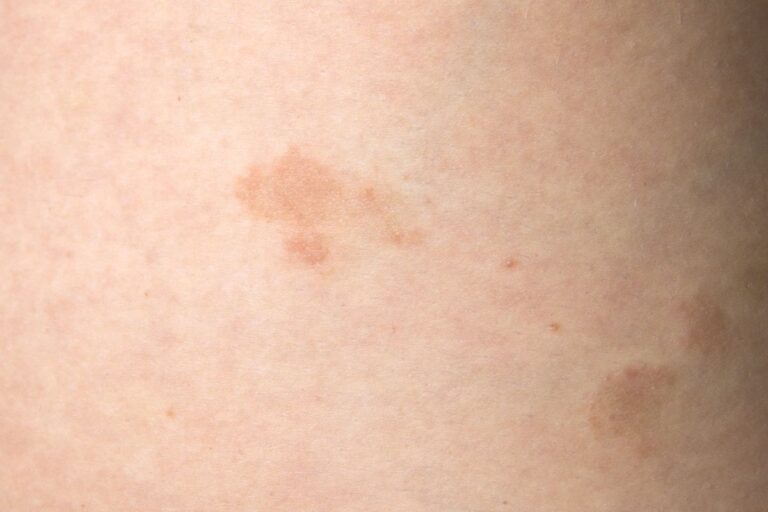 O que Pitiríase Vesicolor? Descubra as principais causas do "pano branco"