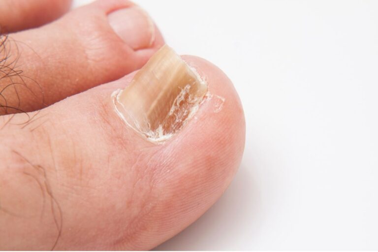 Tipos de micose no pé: conheça as principais infecções fúngicas e como ...